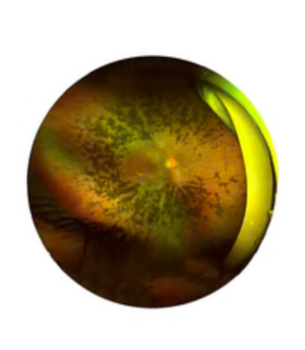 What is Retinitis Pigmentosa (RP) – Unblurred Collection